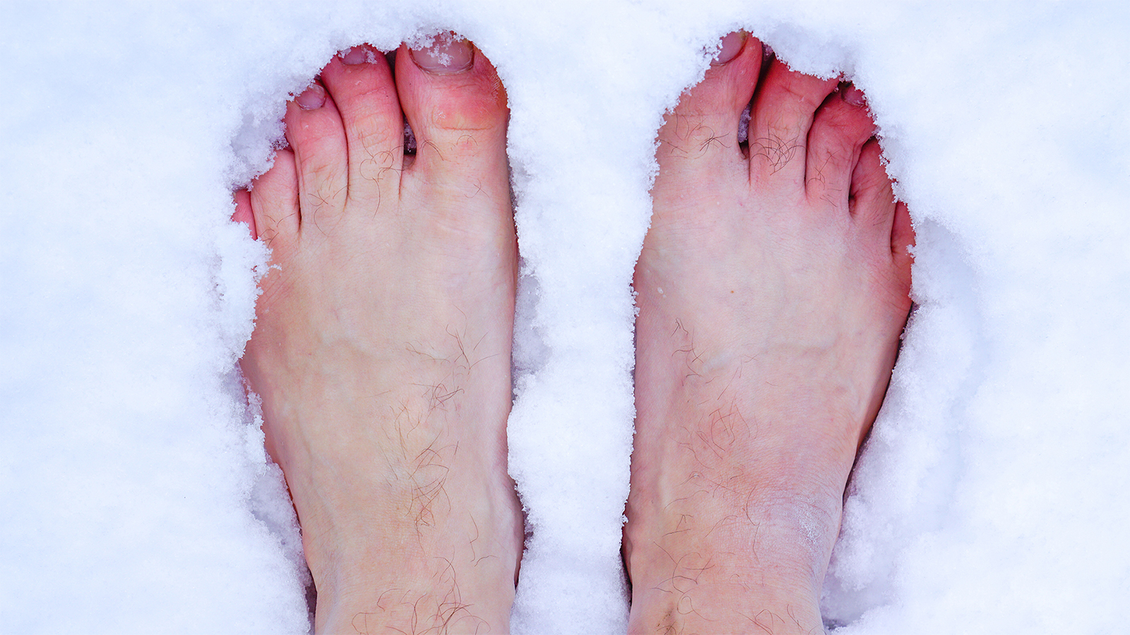 What exactly are chilblains?