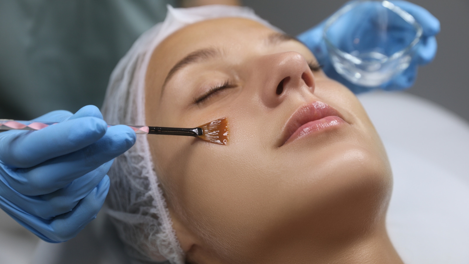 What is a chemical peel?